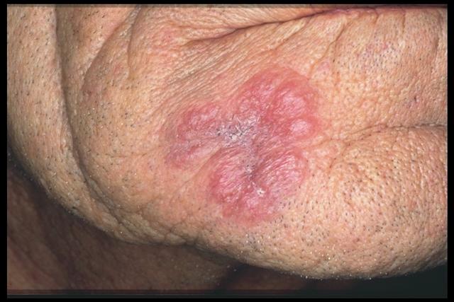 Tuberculosis Lupus Tuberous Picture Hellenic Dermatological Atlas